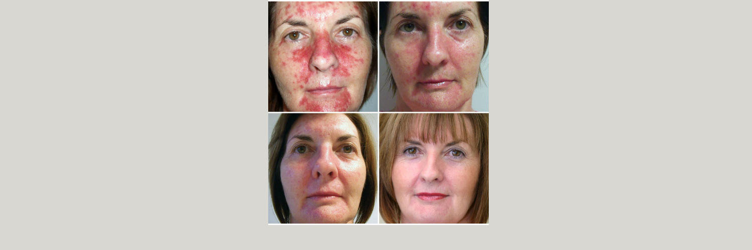 Improve the look and feel of skin during and after Efudex – Simplicite ...