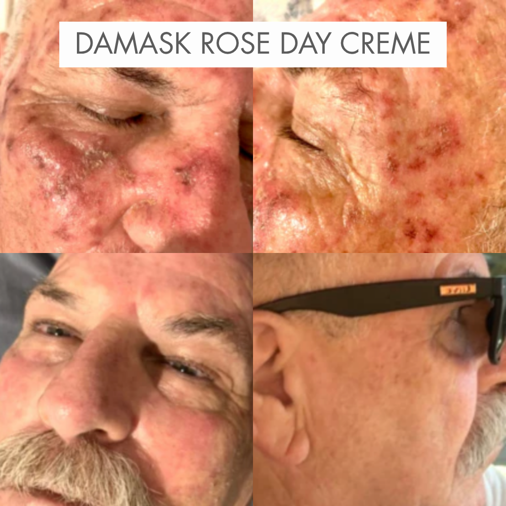 Best moisturiser to use during Efudex treatment – Simplicite Skin Care